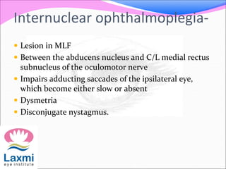Internuclear Ophthalmoplegia Mechanism