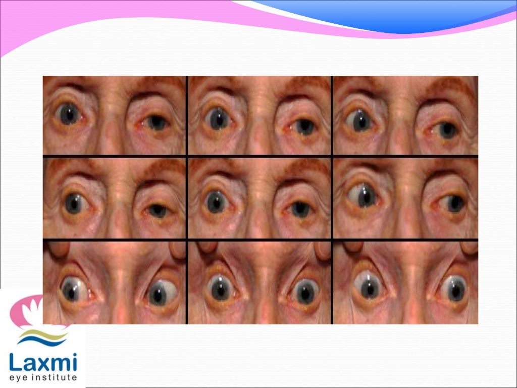 What Is Gaze Palsy | Horizontal gaze palsy – YNAVHY