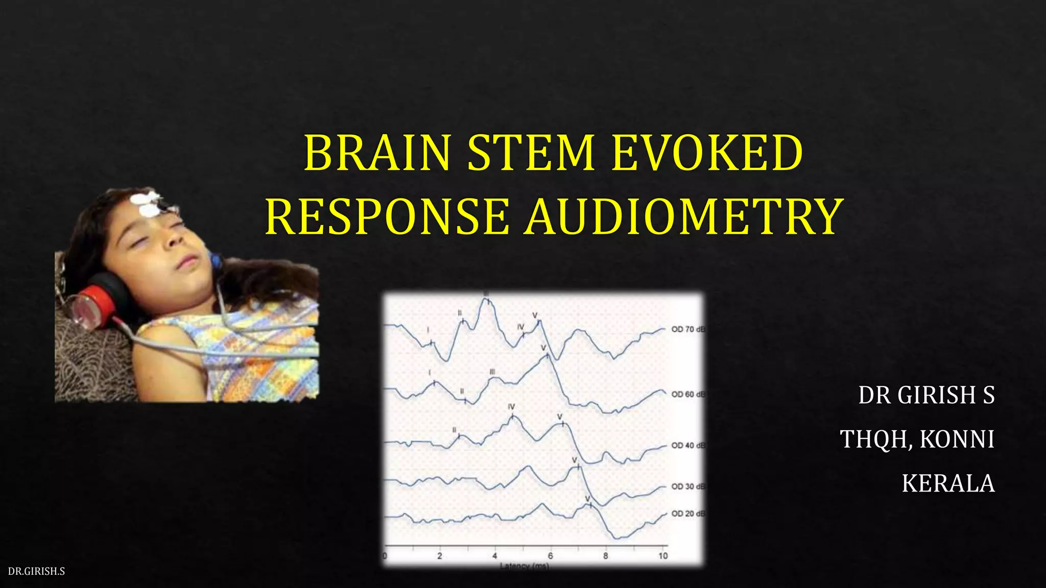 BRAINSTEM EVOKED RESPONSE AUDIOMETRY (BERA), AUDIOTORY BRAINSTEM ...