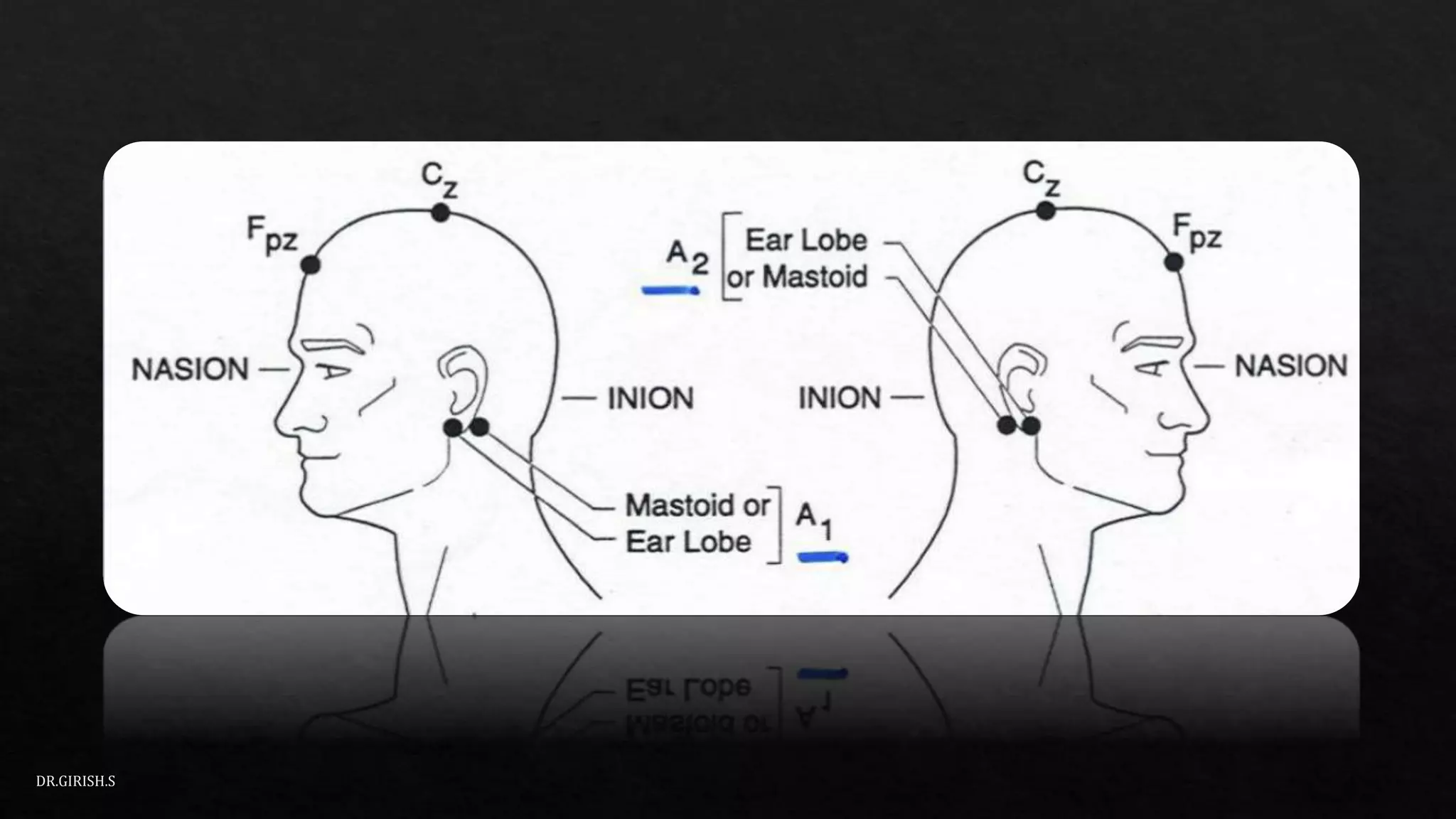 BRAINSTEM EVOKED RESPONSE AUDIOMETRY (BERA), AUDIOTORY BRAINSTEM ...