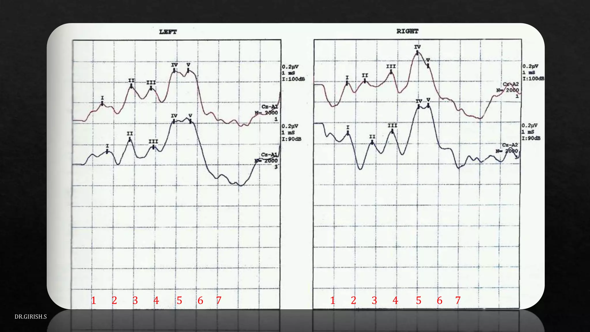 BRAINSTEM EVOKED RESPONSE AUDIOMETRY (BERA), AUDIOTORY BRAINSTEM ...