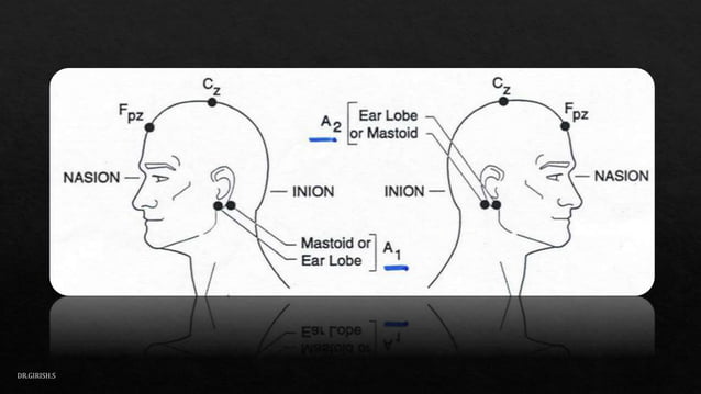 BRAINSTEM EVOKED RESPONSE AUDIOMETRY (BERA), AUDIOTORY BRAINSTEM ...