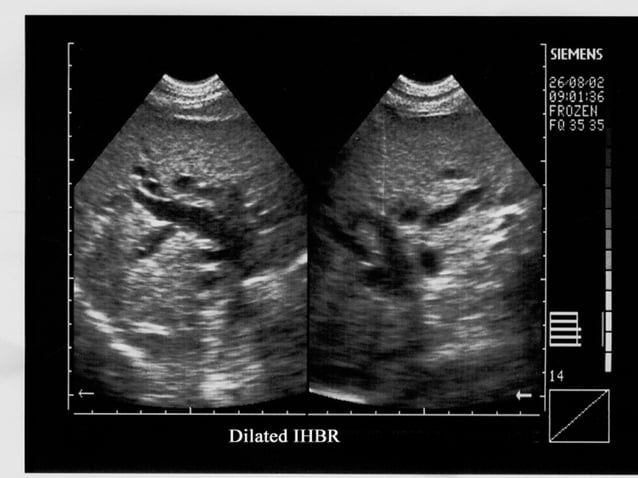Gb nd biliary tree imaging | PPT