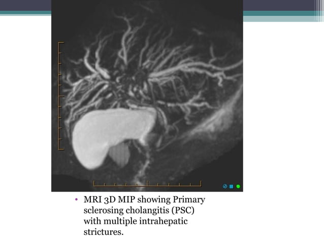 Gb nd biliary tree imaging | PPT