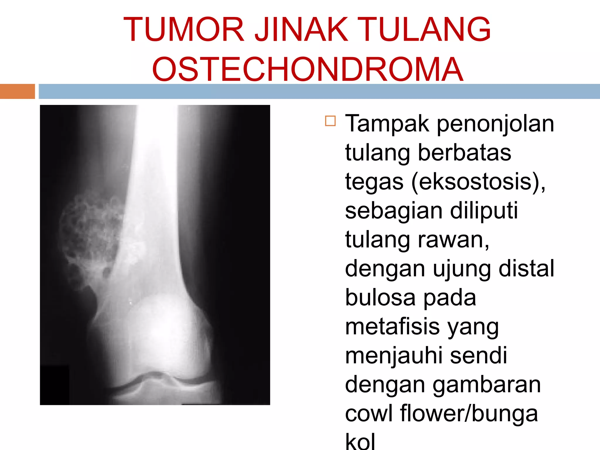 Gbr bimb tumor tulang | PPT