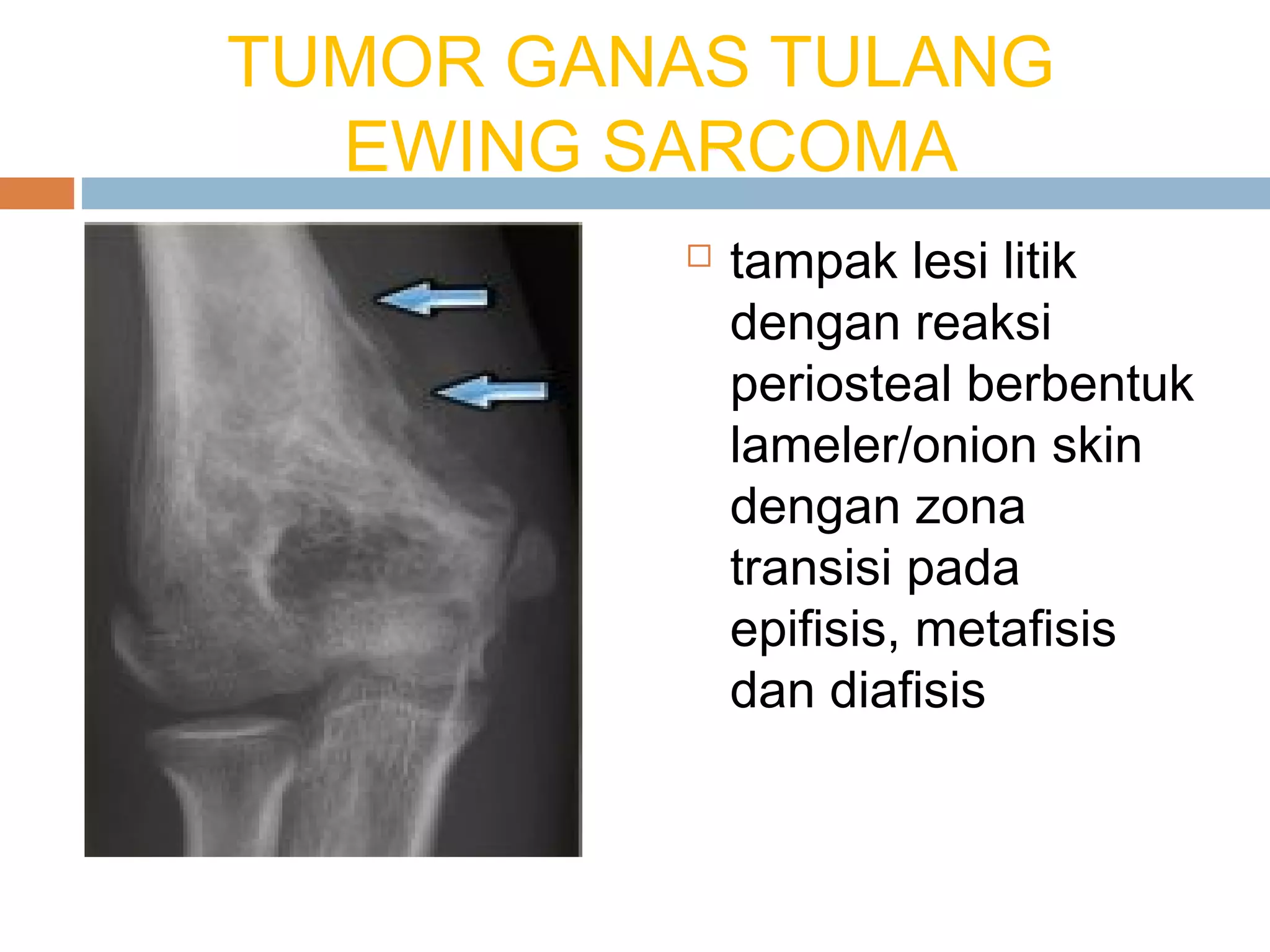 Gbr bimb tumor tulang | PPT