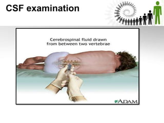 Guillain-Barré syndrome (GBS) | PPTX