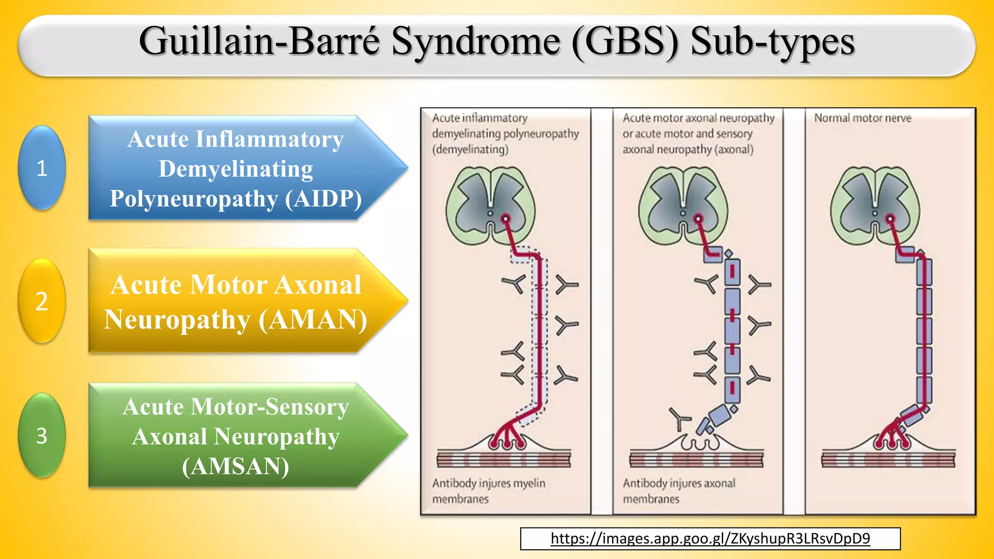 Guillain-Barré Syndrome (GBS).pdf