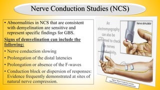Guillain-Barré Syndrome (GBS).pdf