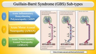 Guillain-Barré Syndrome (GBS).pdf
