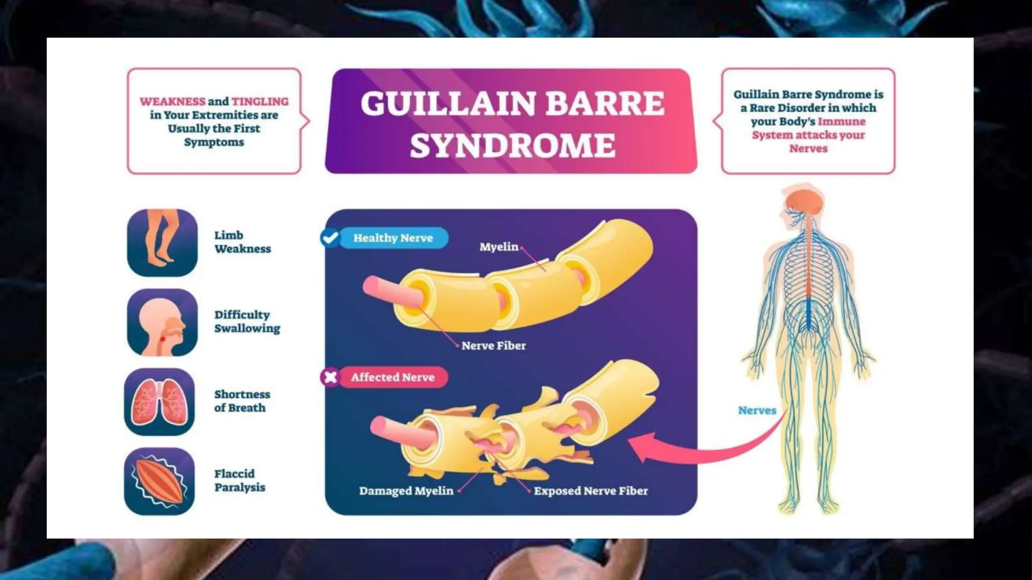 Guillain Barre syndrome (GBS) slide share | PPTX