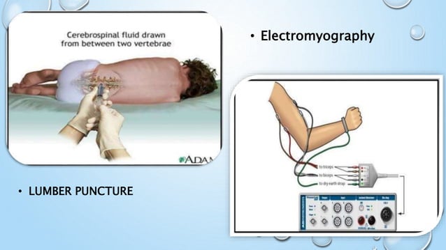 Guillain Barre syndrome (GBS) in brief PPT | PPTX | Physical Therapy ...
