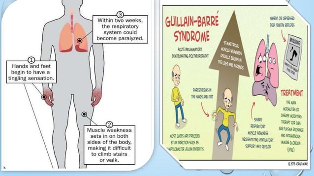Guillain Barre syndrome (GBS) in brief PPT | PPTX | Physical Therapy ...