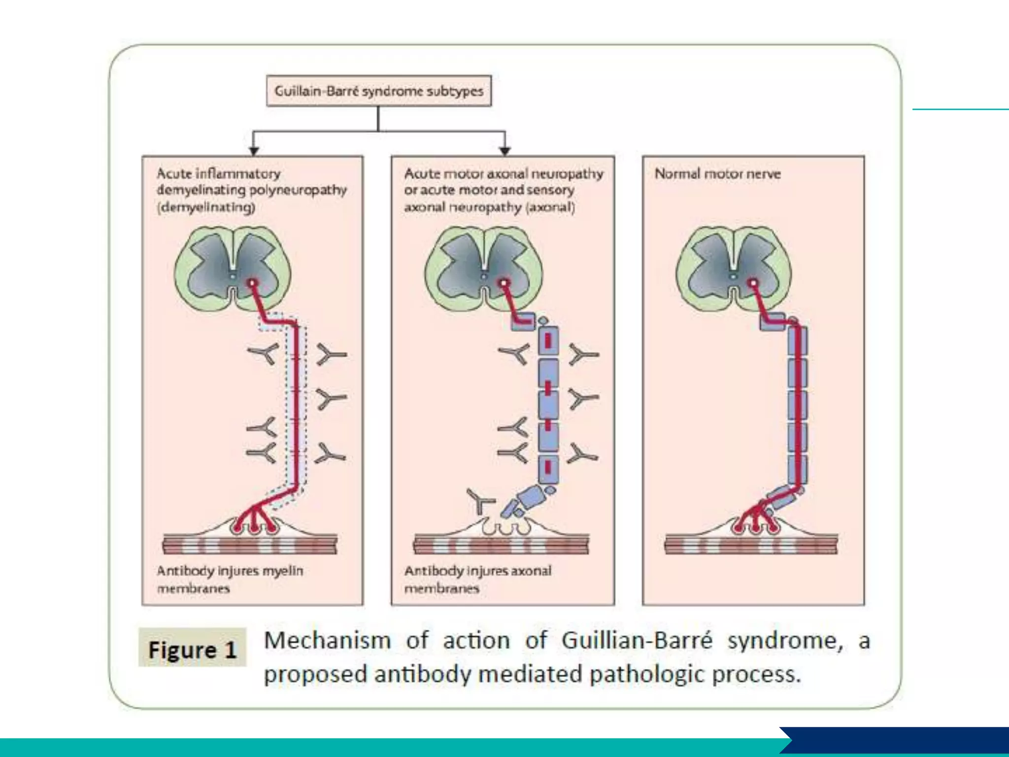 GULLIAN BARRE SYNDROME | PPTX