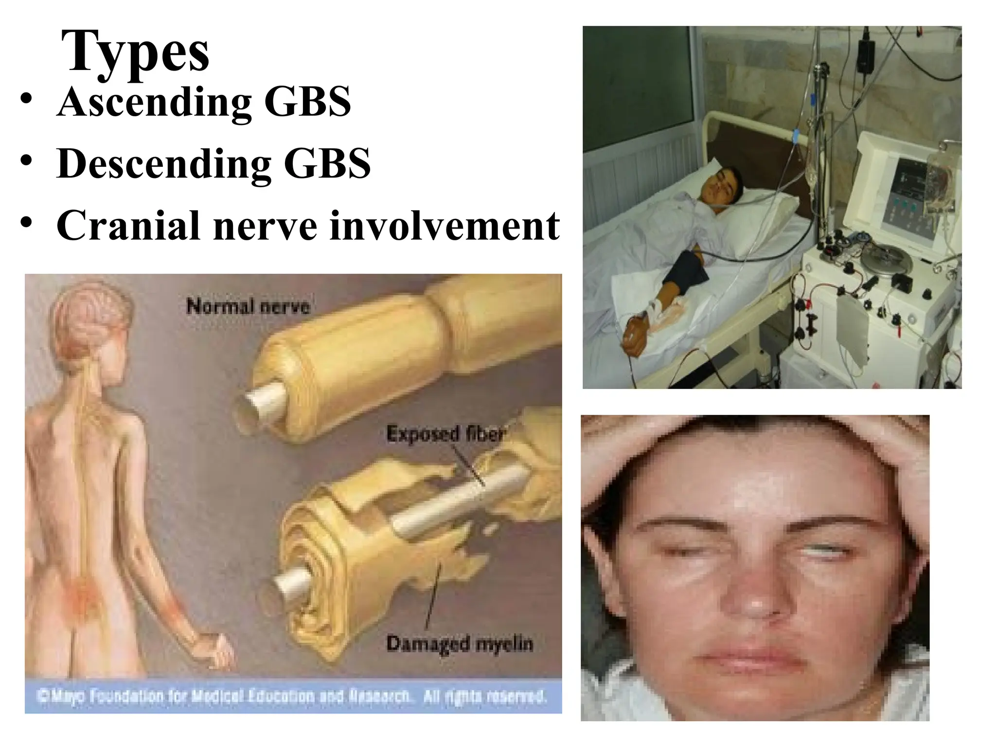 Glubarin bulurin syndrome class 1 GBs.pptx