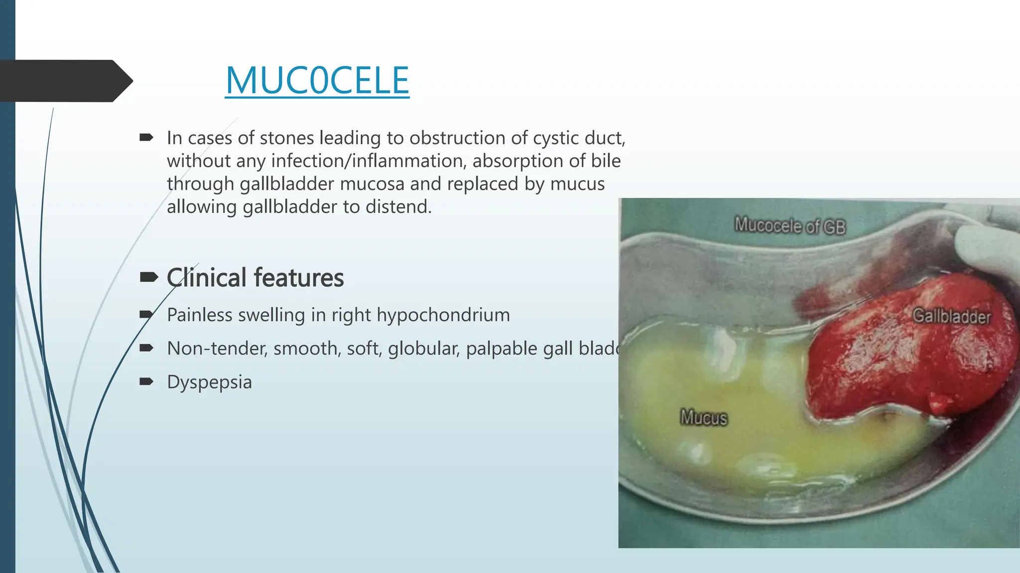 Gall bladder stone disease surgical perspective | PPTX