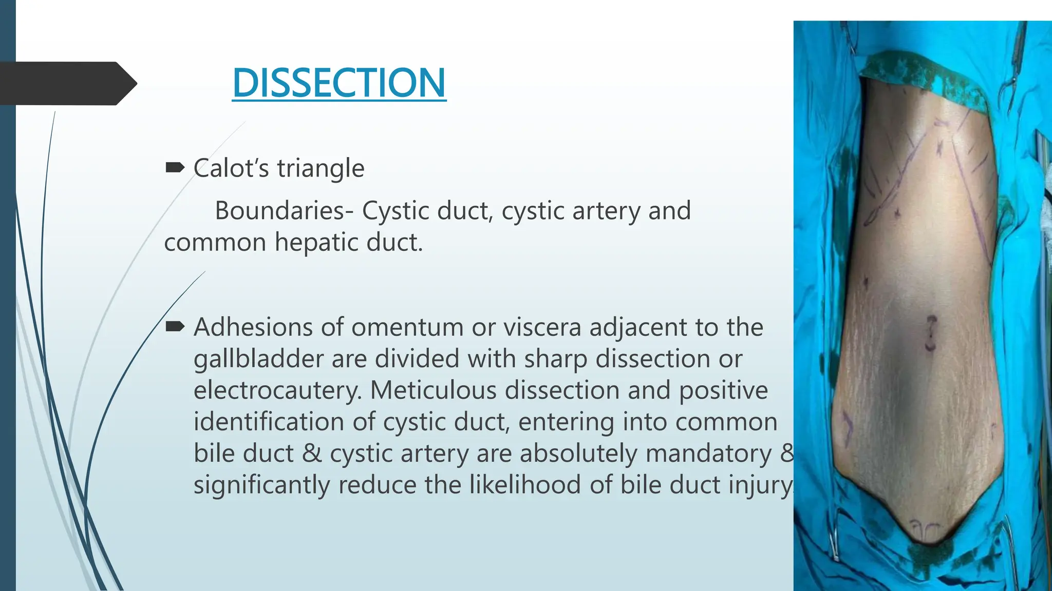 Gall bladder stone disease surgical perspective | PPTX