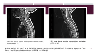 GBS vs Transverse myelitis tugas ppt neuro | PPTX