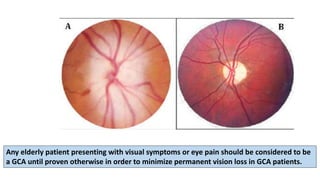 Gaint cell arteritiis (GCA) | PPTX