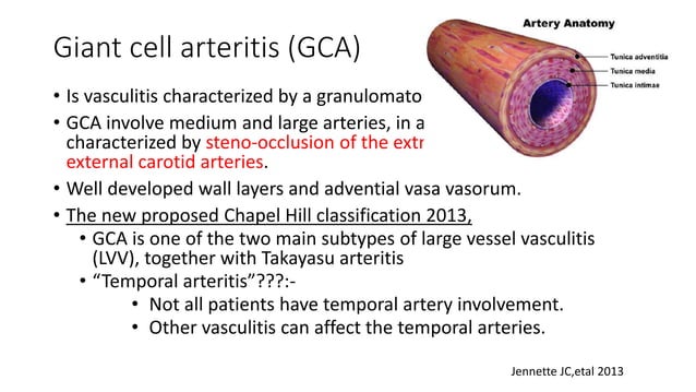 Gaint cell arteritiis (GCA) | PPTX | Diseases and Conditions | Medical ...