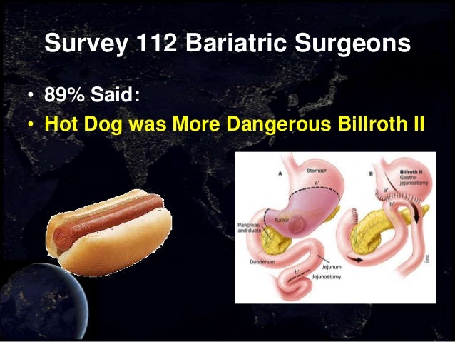 Gastric Bypass Billroth I Versus Billroth Ii Anatomy