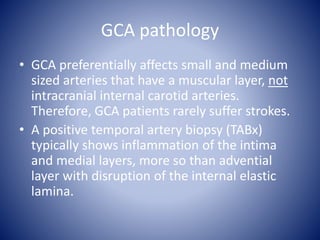 Review of Giant Cell Arteritis | PPTX