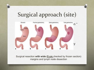 Gastric cancer Treatment | PPTX