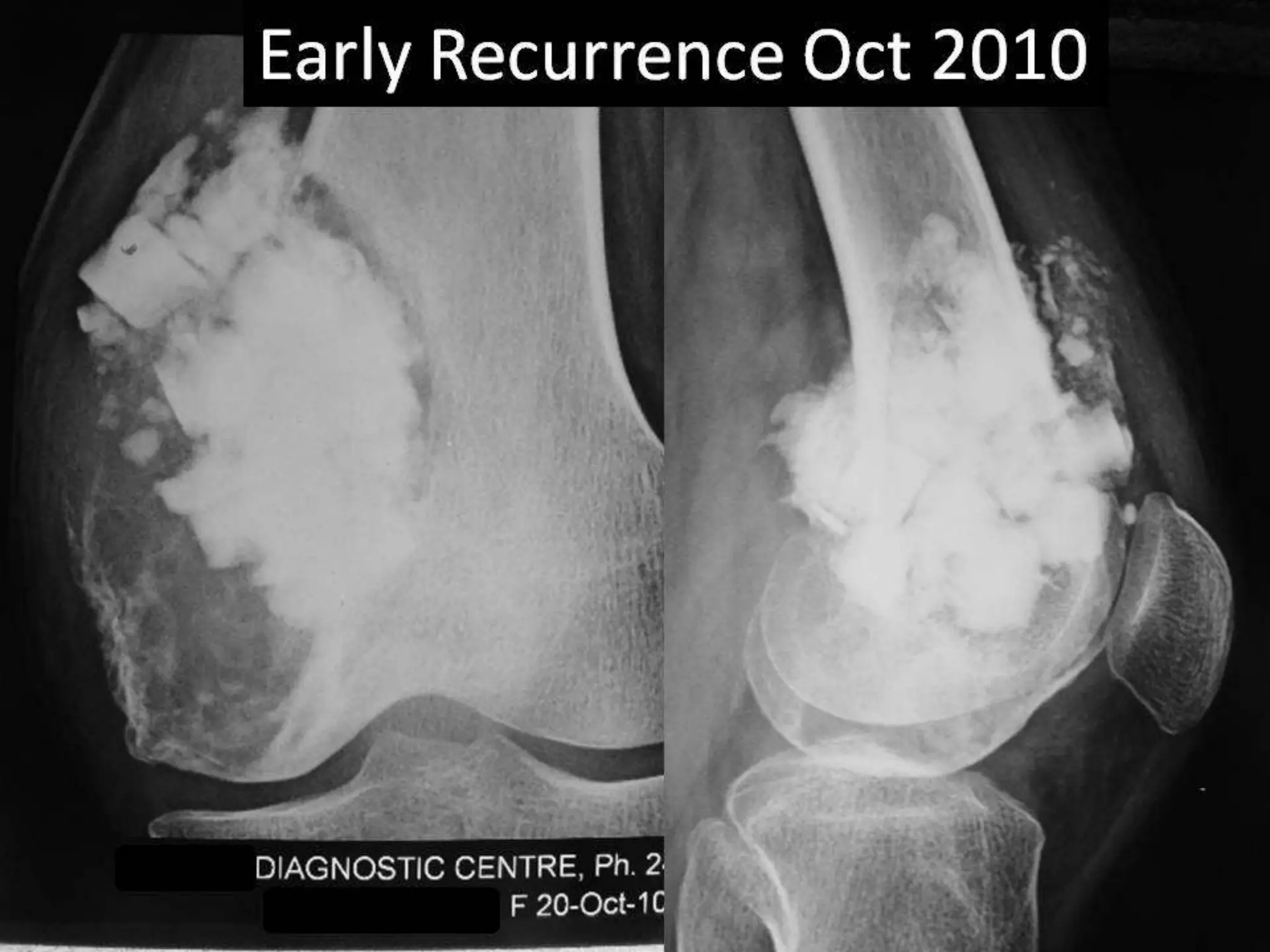 Recurrence of Gct lower end femur - a case report | PPTX