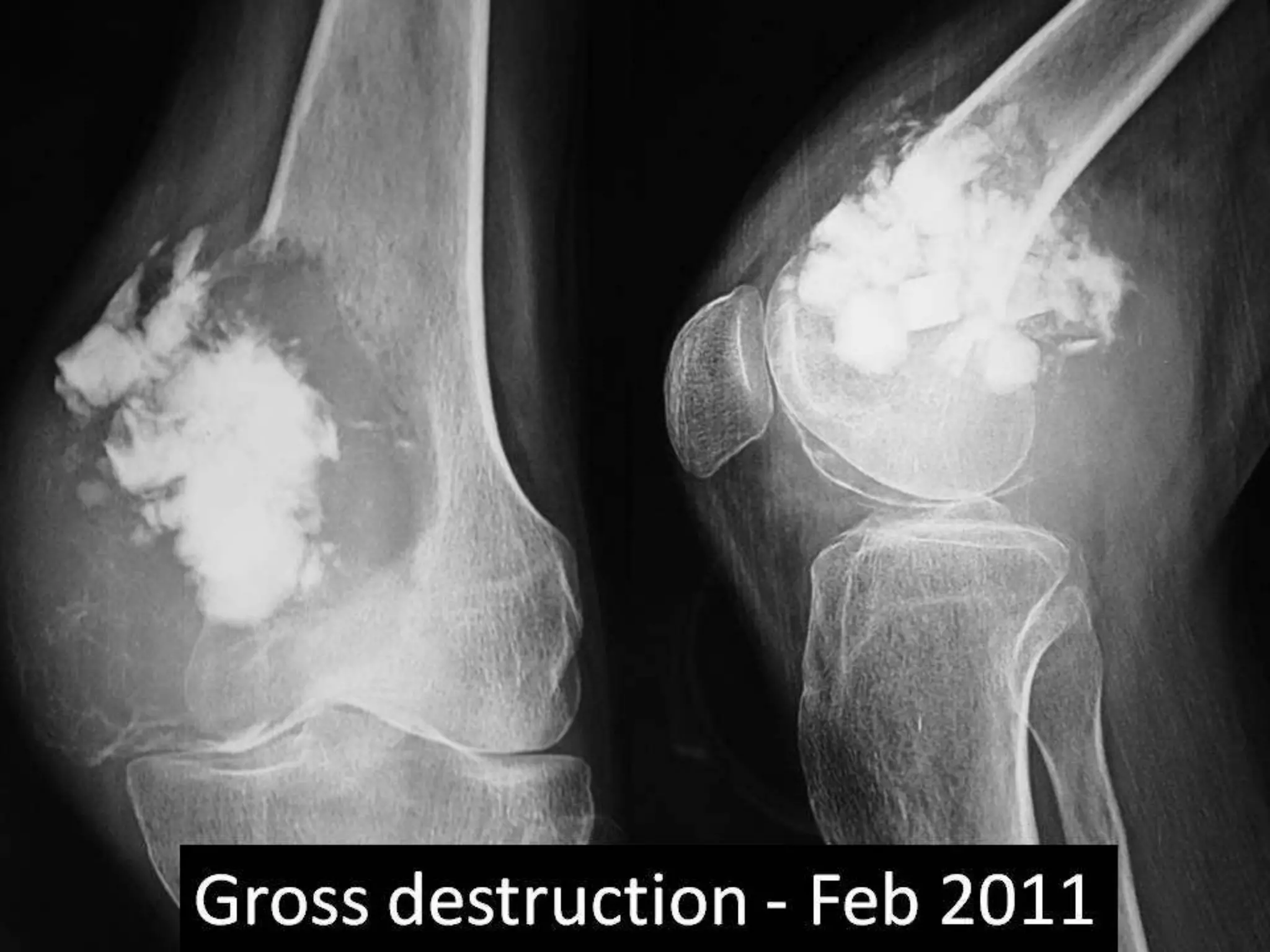 Recurrence of Gct lower end femur - a case report | PPTX