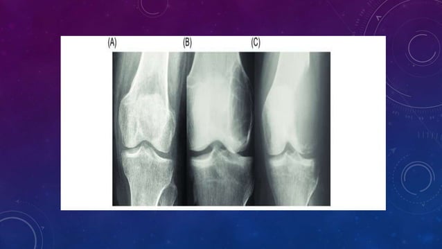 Gct of distal femur | PPT