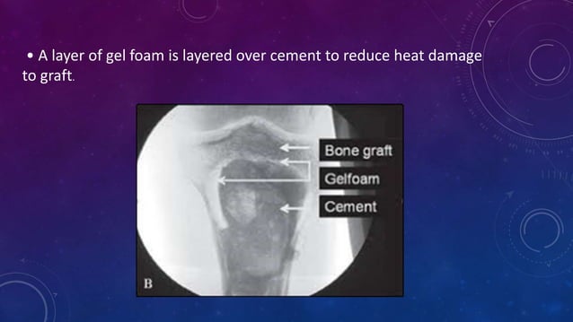 Gct of distal femur | PPT