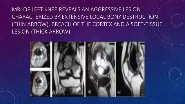 Gct of distal femur | PPT