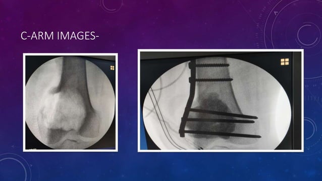 Gct of distal femur | PPT