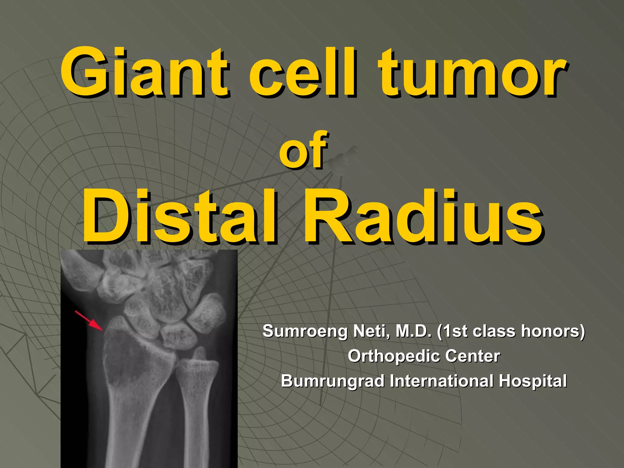 Gct of distal radius | PPT