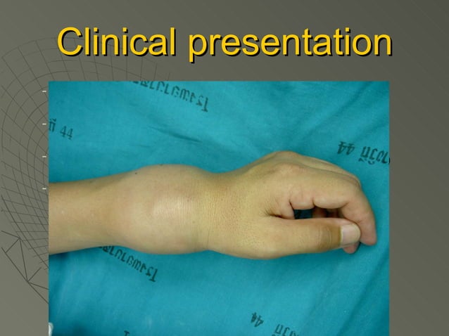 Gct of distal radius | PPT
