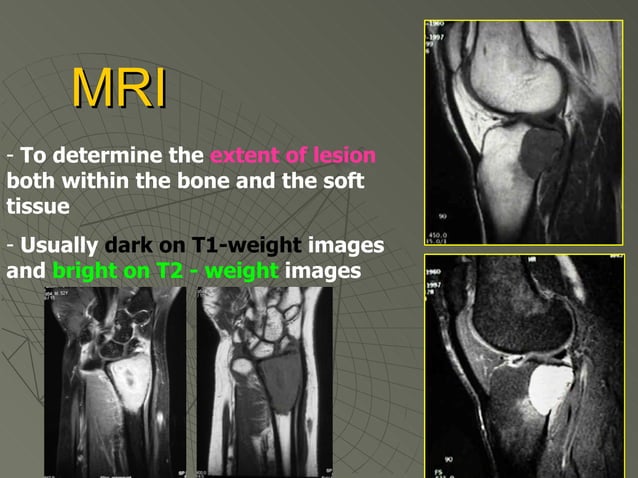 Gct of distal radius | PPT