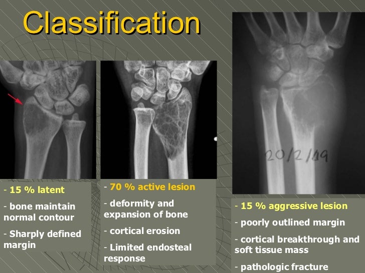 Gct of distal radius