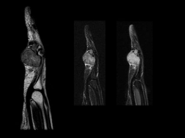 Gct tendon sheath mercury imaging | PPTX