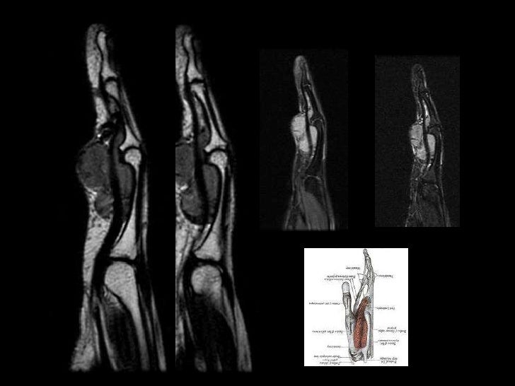 Gct tendon sheath mercury imaging