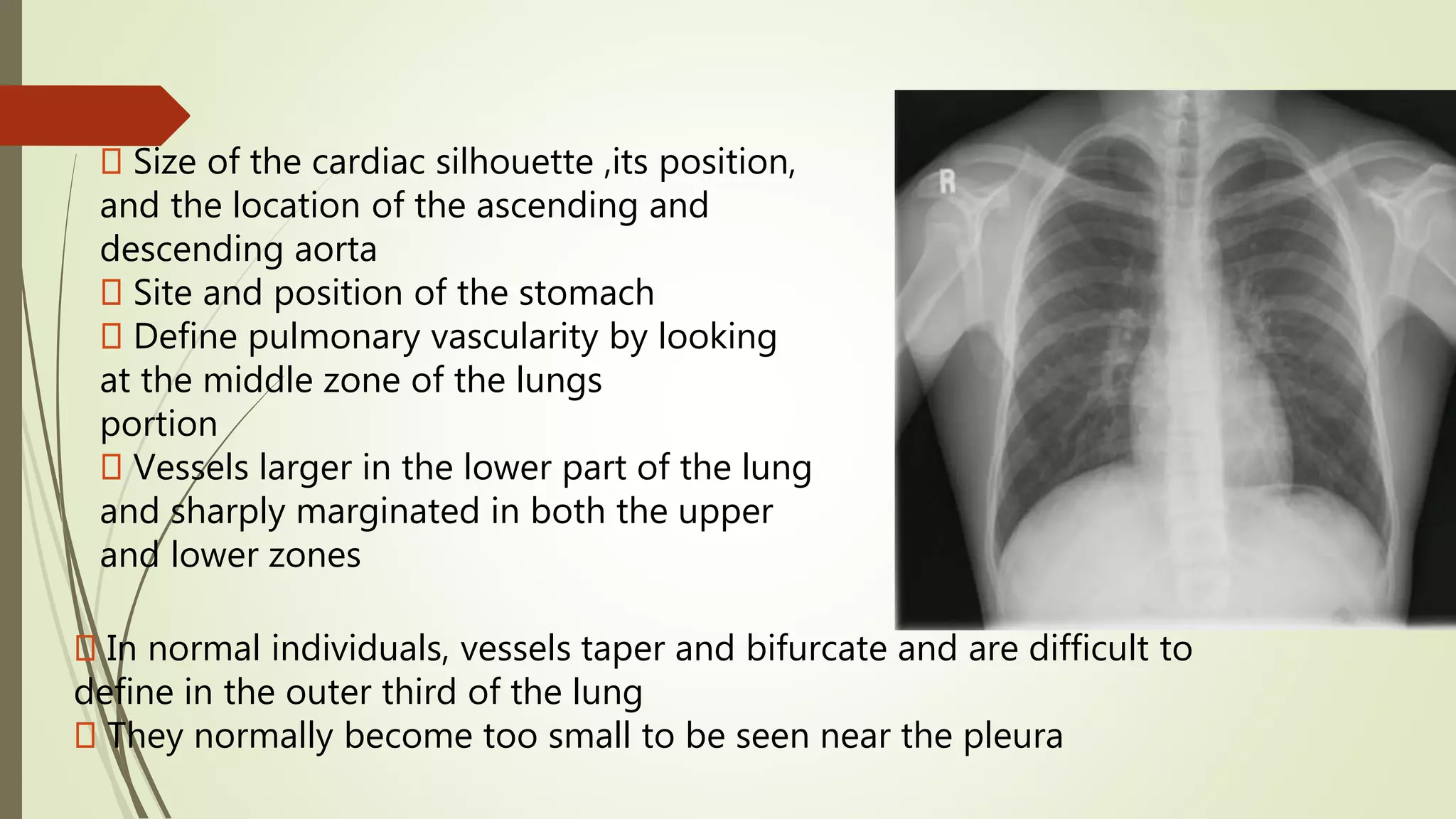 chest xray of cardiovascular disease PPT | PPTX