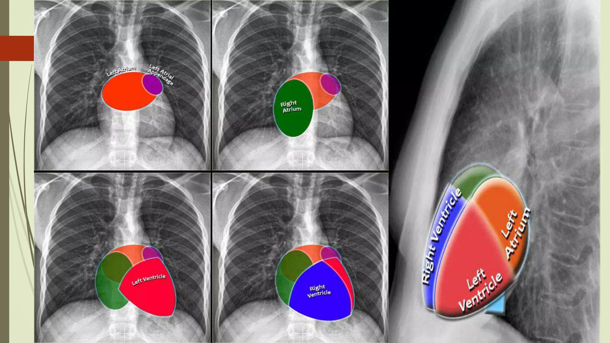 chest xray of cardiovascular disease PPT | PPTX