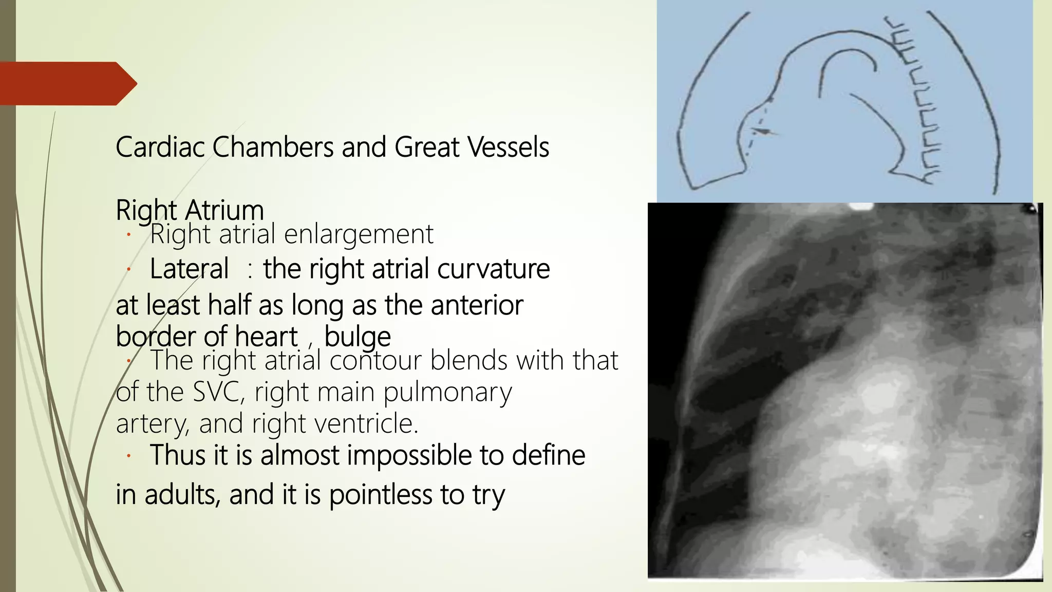 chest xray of cardiovascular disease PPT | PPTX