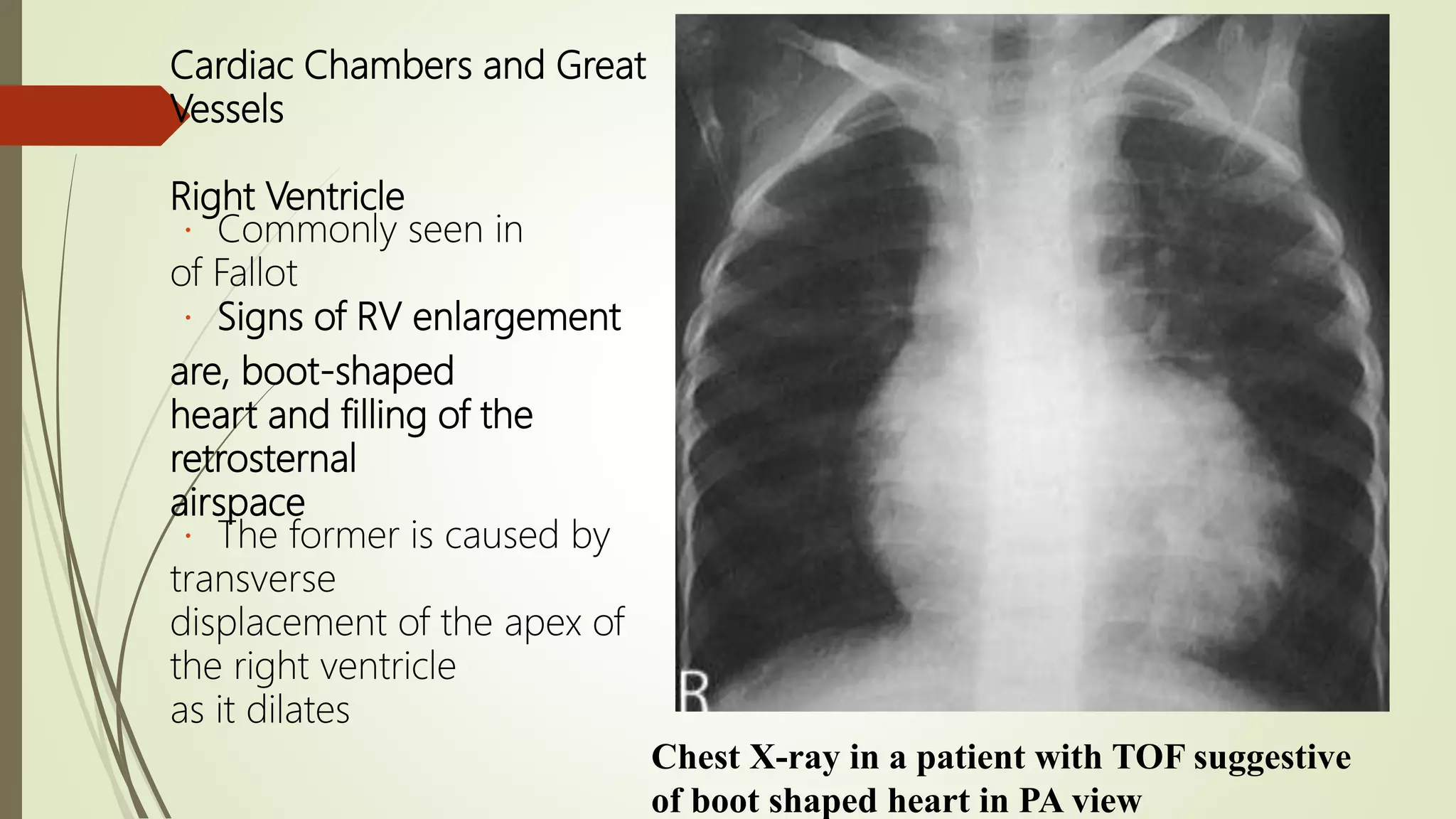 chest xray of cardiovascular disease PPT | PPTX