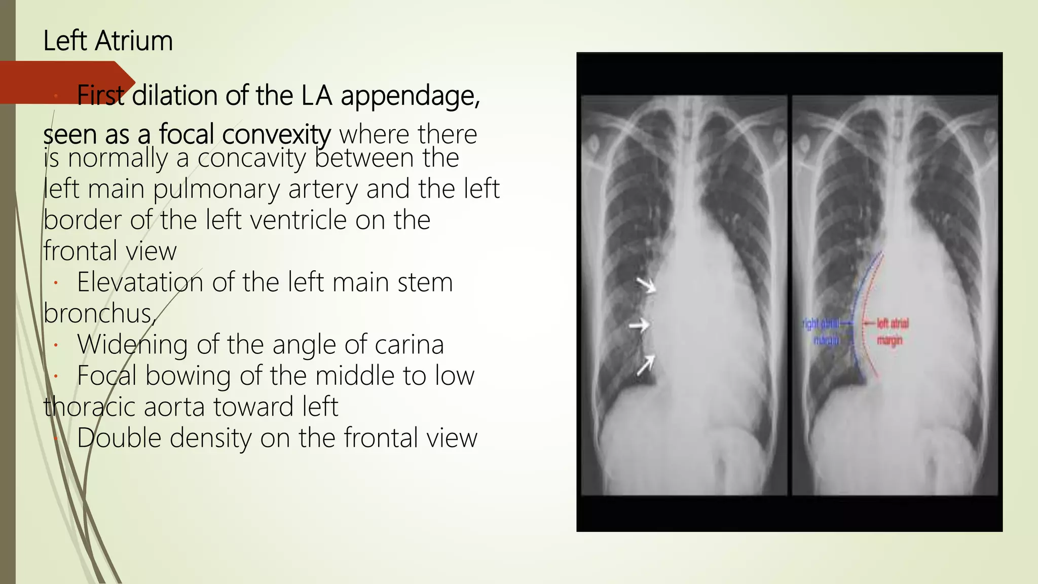 chest xray of cardiovascular disease PPT | PPTX