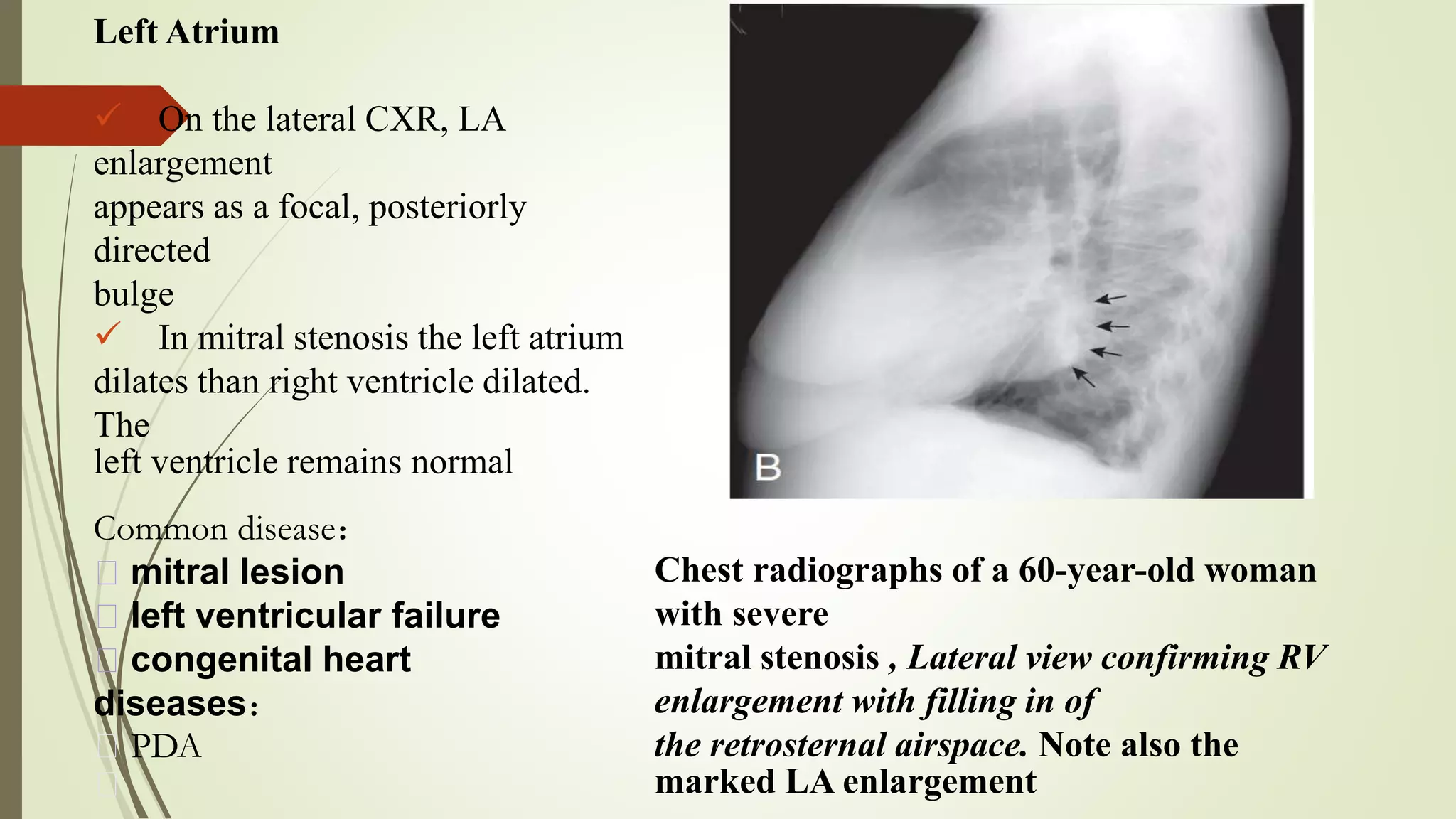 chest xray of cardiovascular disease PPT | PPTX