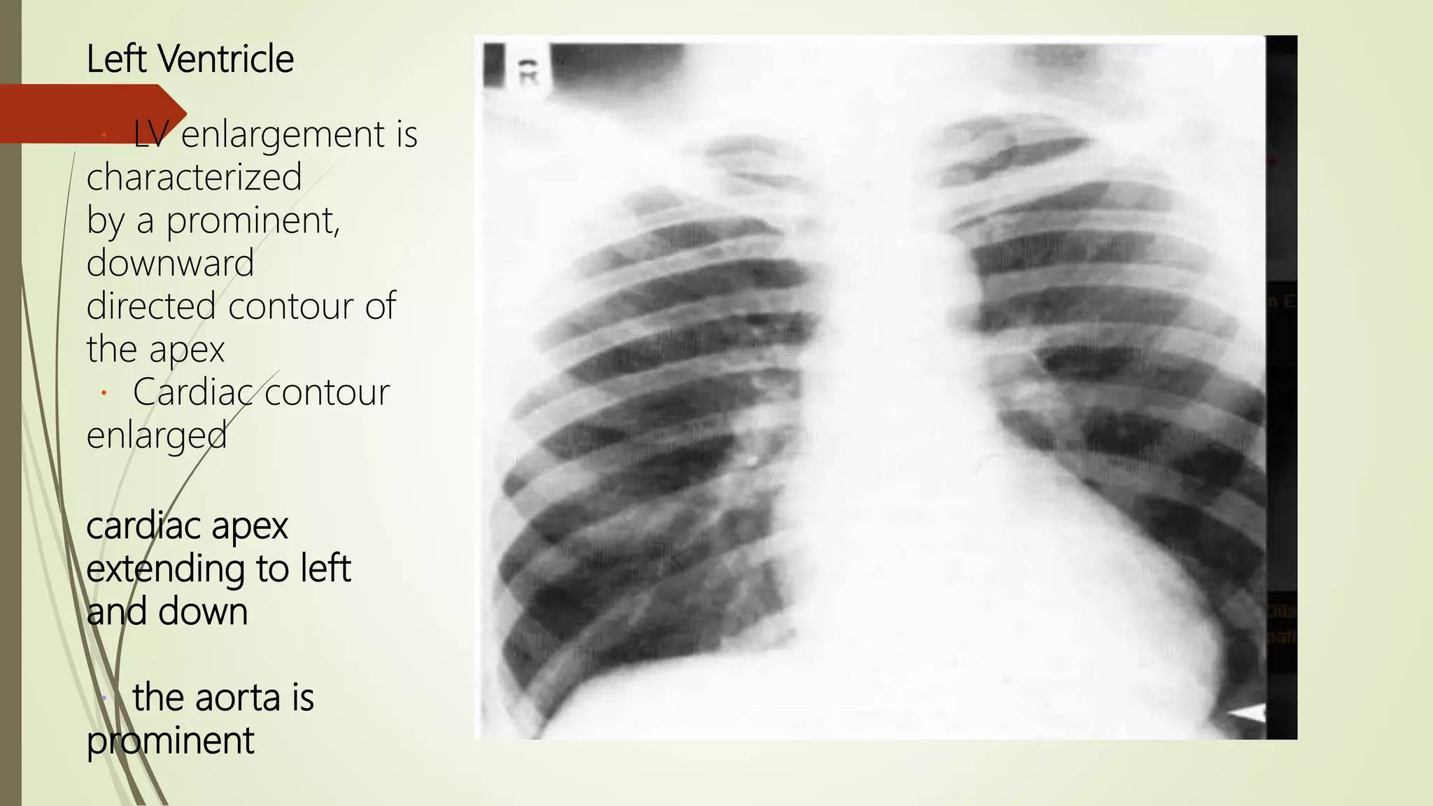 chest xray of cardiovascular disease PPT | PPTX