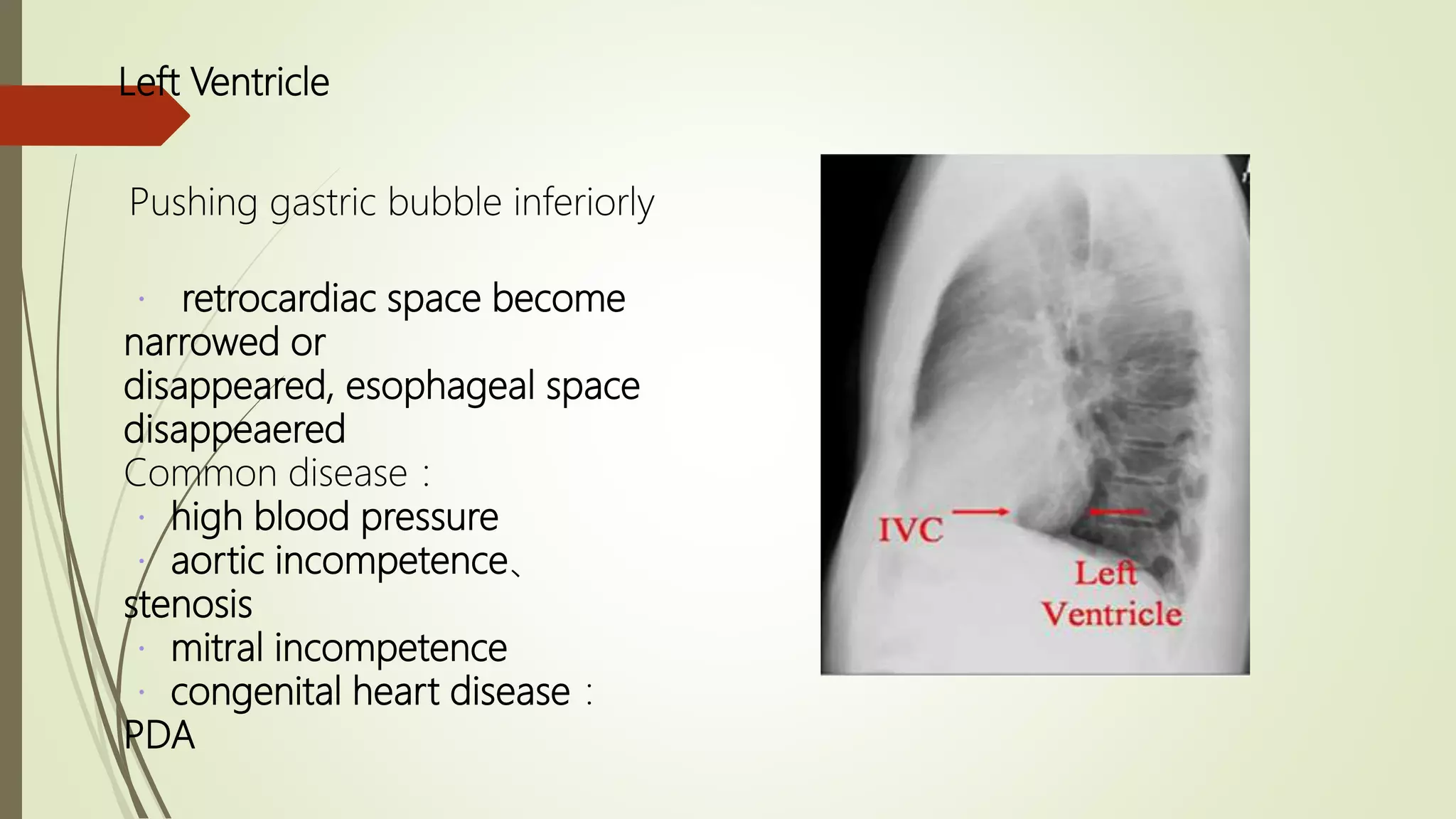 chest xray of cardiovascular disease PPT | PPTX