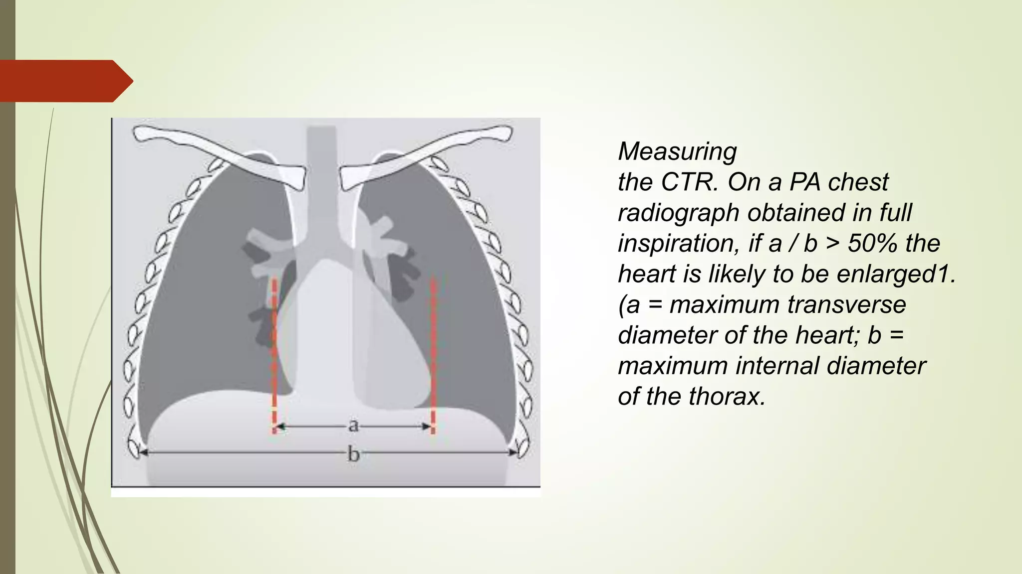 chest xray of cardiovascular disease PPT | PPTX