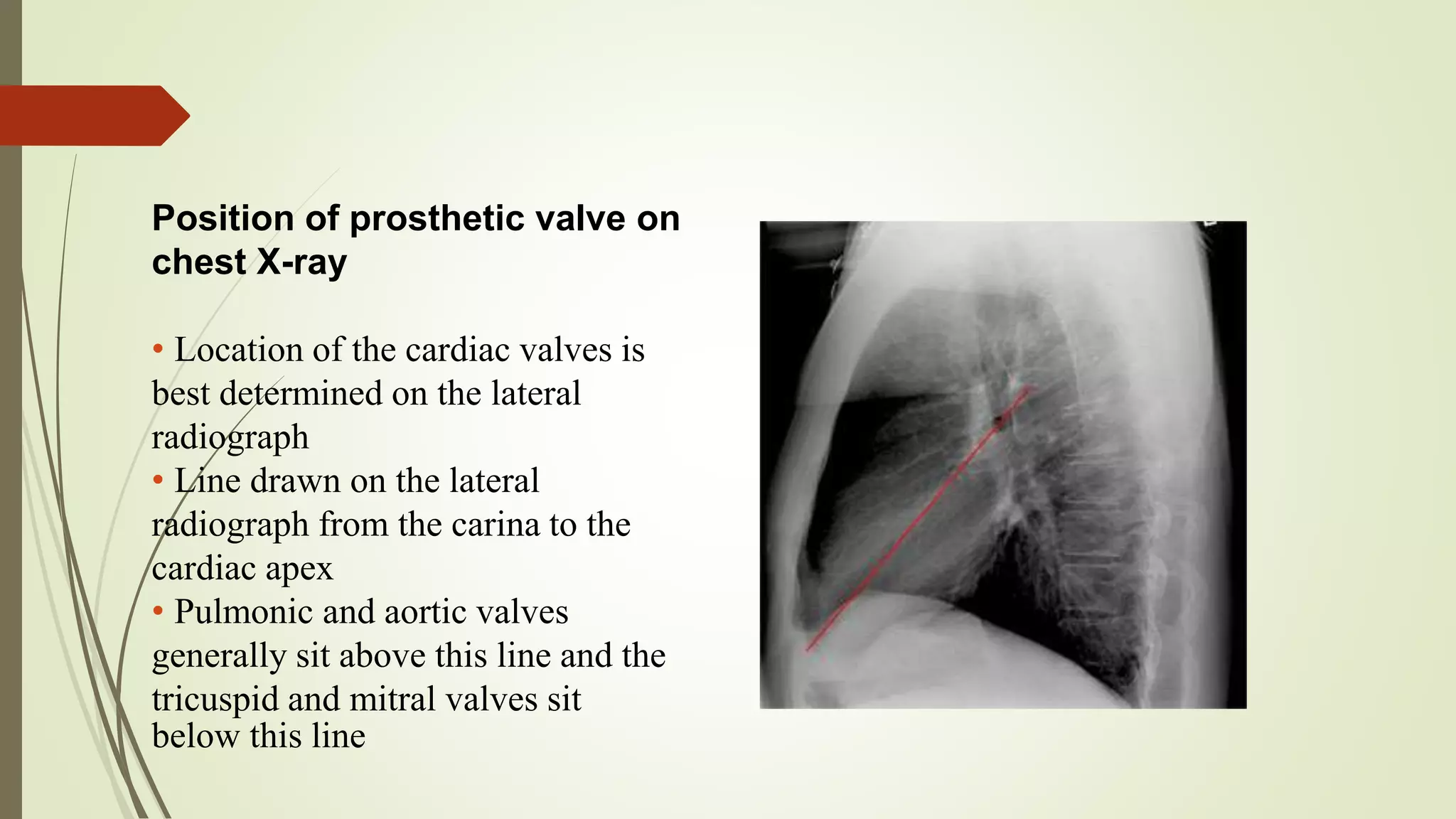 chest xray of cardiovascular disease PPT | PPTX