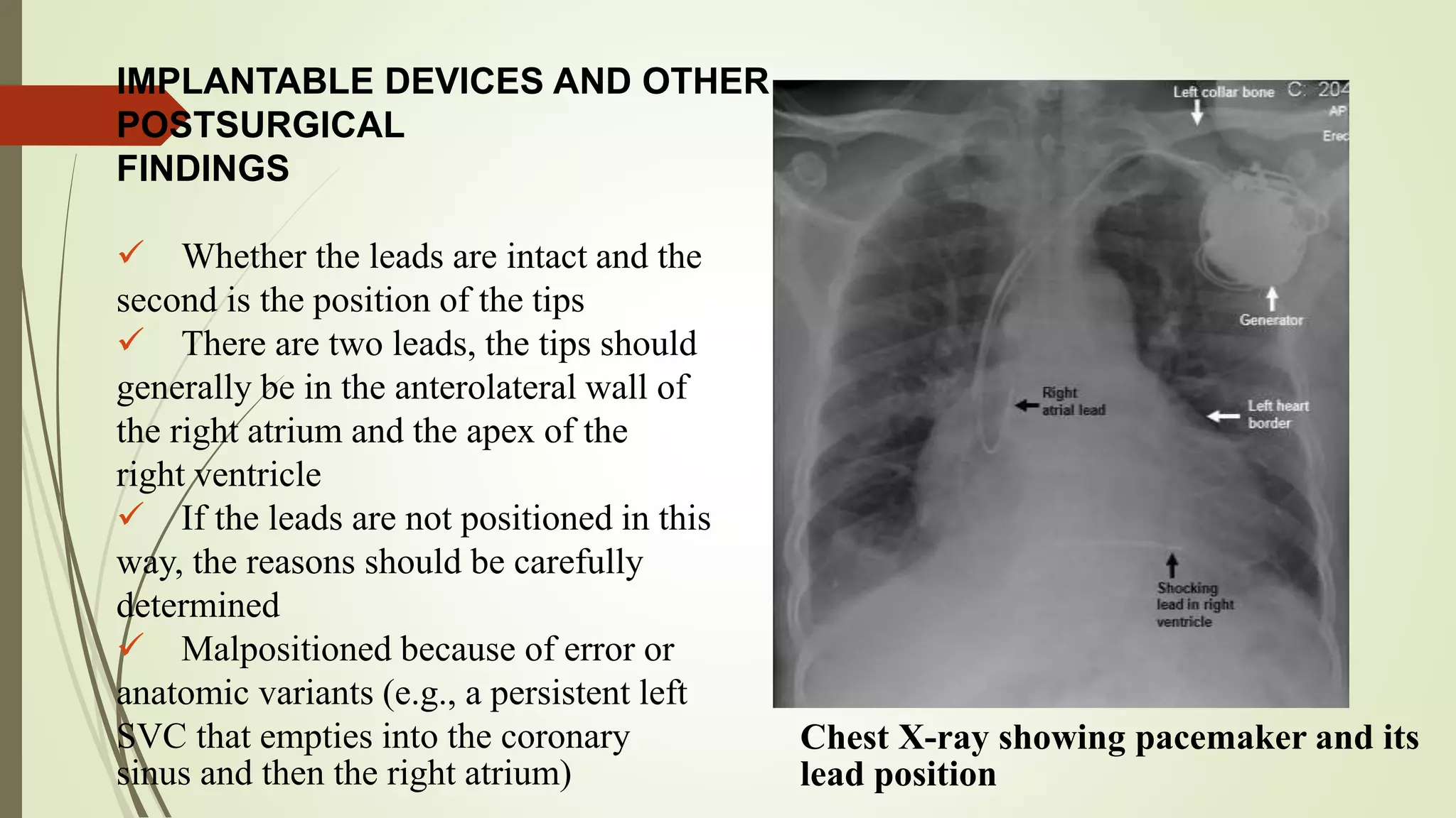 chest xray of cardiovascular disease PPT | PPTX